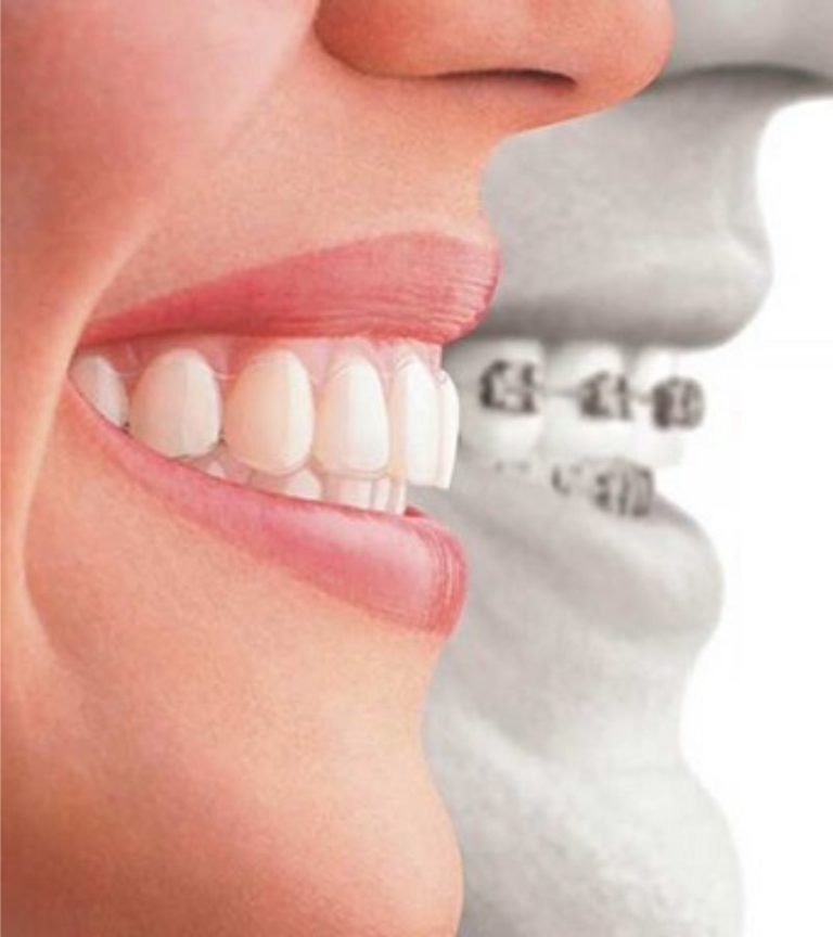 Invisalign - Clínica Bulla Odontologia - Centro de São Leopoldo